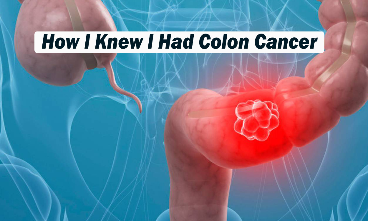 How I Knew I Had Colon Cancer - HealthTeps